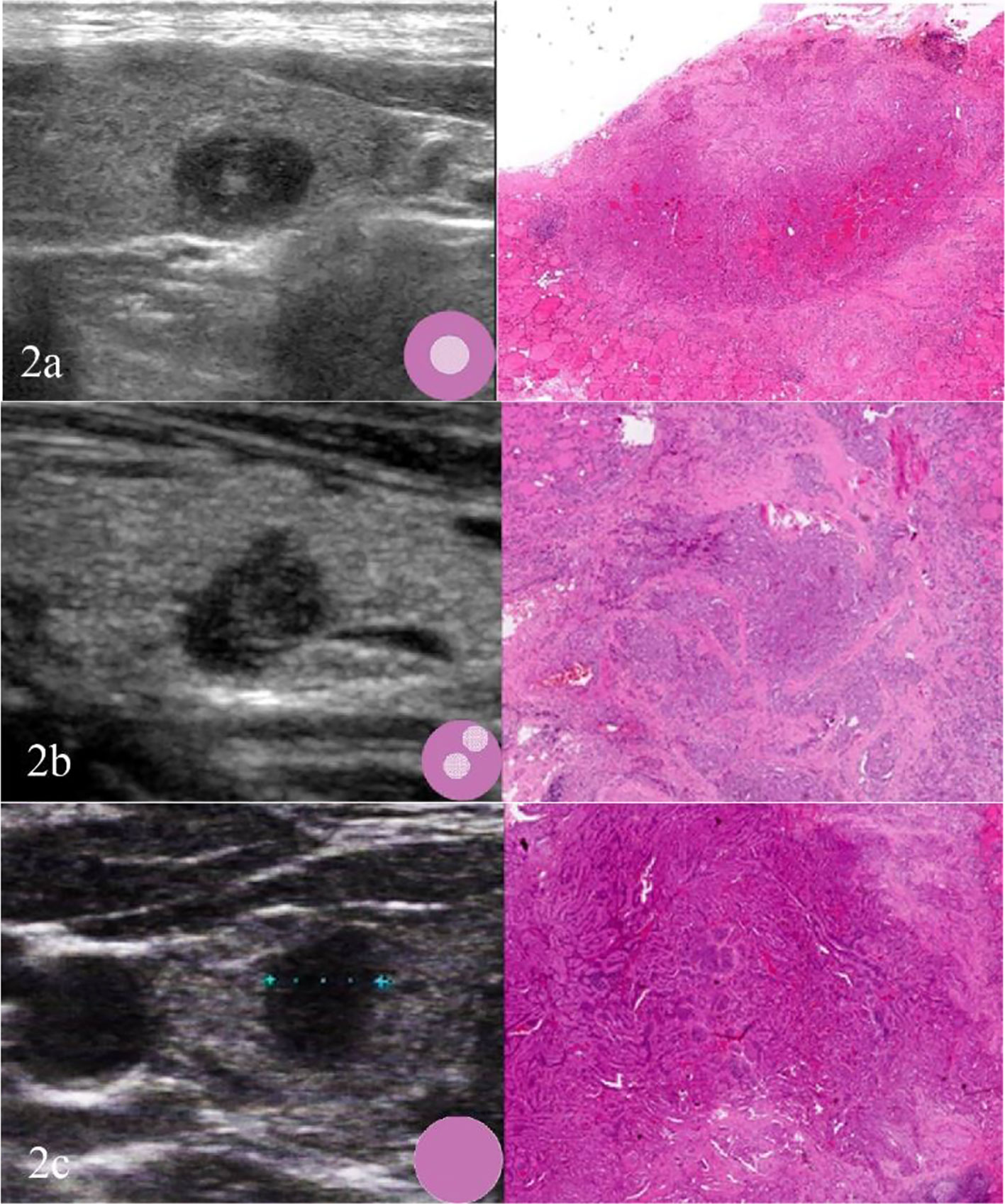 Frontiers Reconceptualize Tall Cell Variant Papillary Thyroid