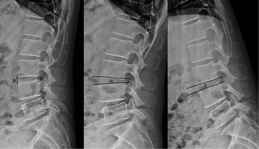 Discectomy Before And After