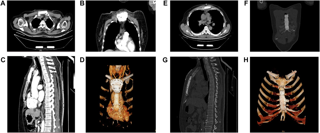 Frontiers Primary Sternal Tumour Resection And Reconstruction With 