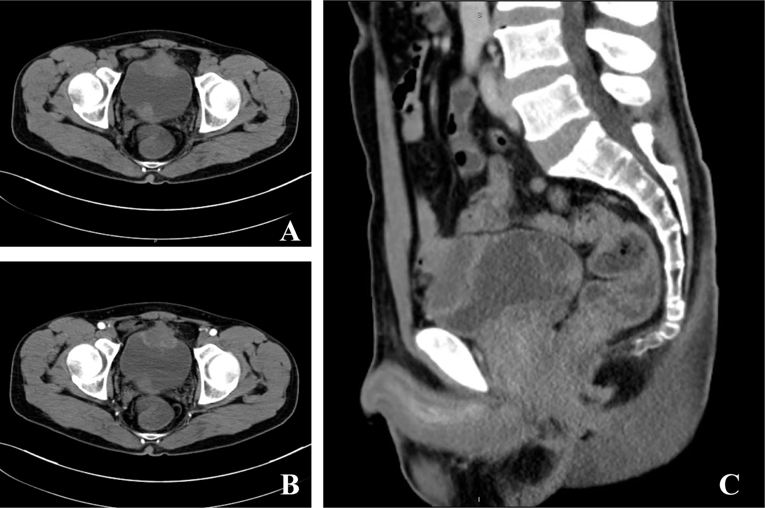 Frontiers Primary Urachal Signet Ring Cell Carcinoma A Case Report