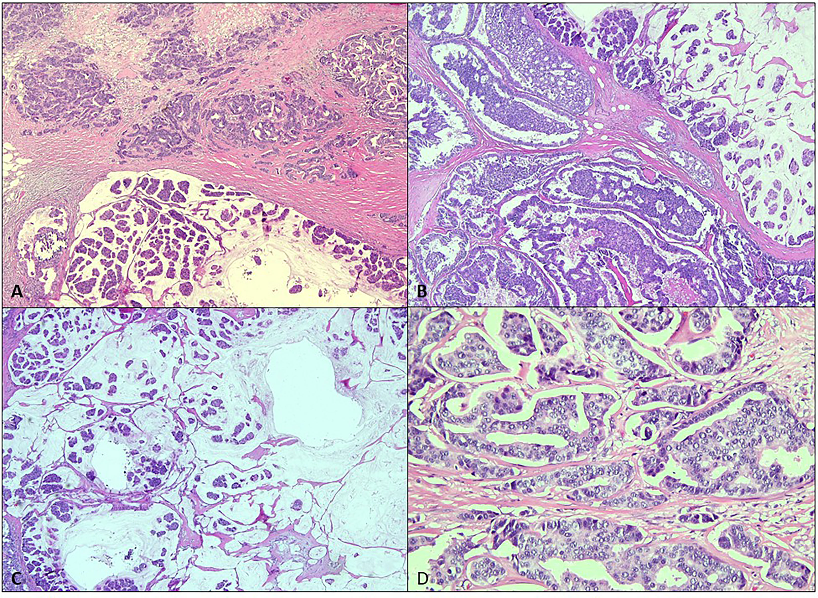 Frontiers Bilateral Metachronous Breast Malignancies Malignant