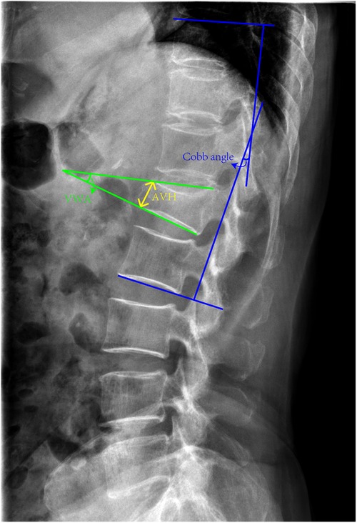 Frontiers Efficacy Of A Novel Percutaneous Pedicle Screw Fixation And