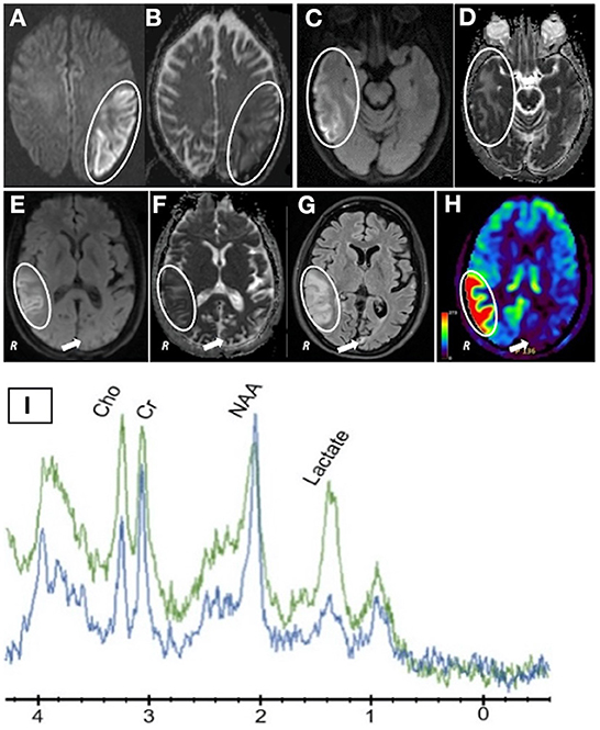 Frontiers Case Report Melas And Concomitant Presumed