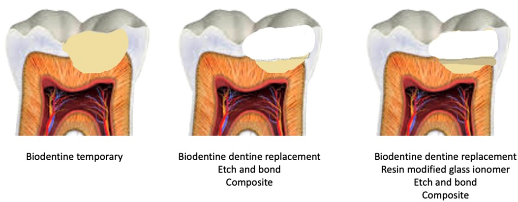 Frontiers The Scientific Management Of Deep Carious Lesions In Vital
