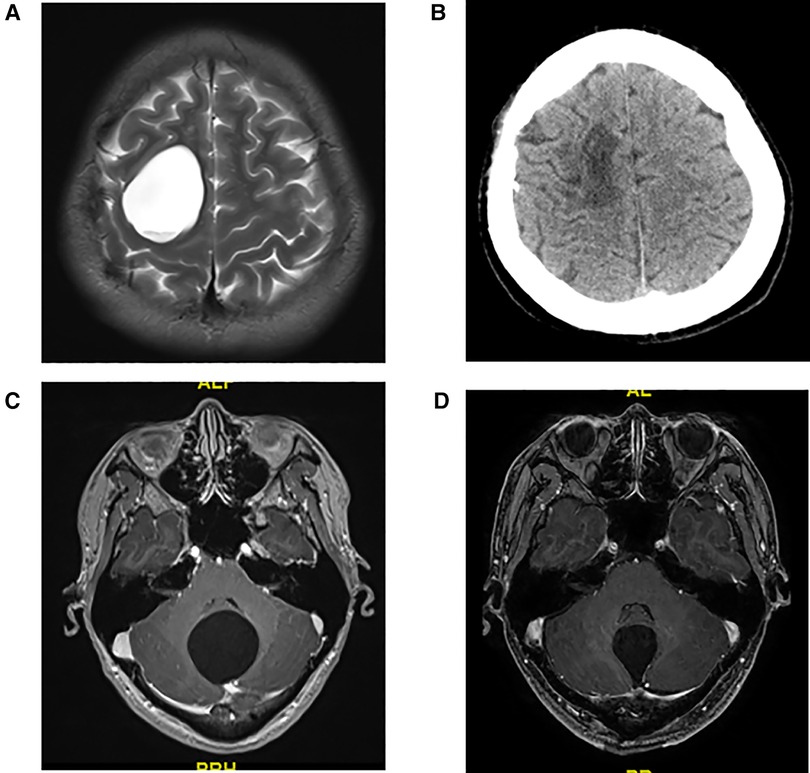 Frontiers Effect Comparison Of Neuroendoscopic Vs Craniotomy In The Treatment Of Adult