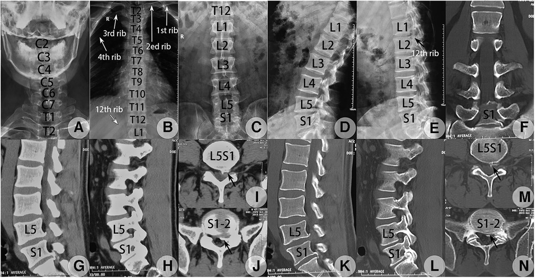 Frontiers Complete Lumbarization With Calcified Disc 46 Off
