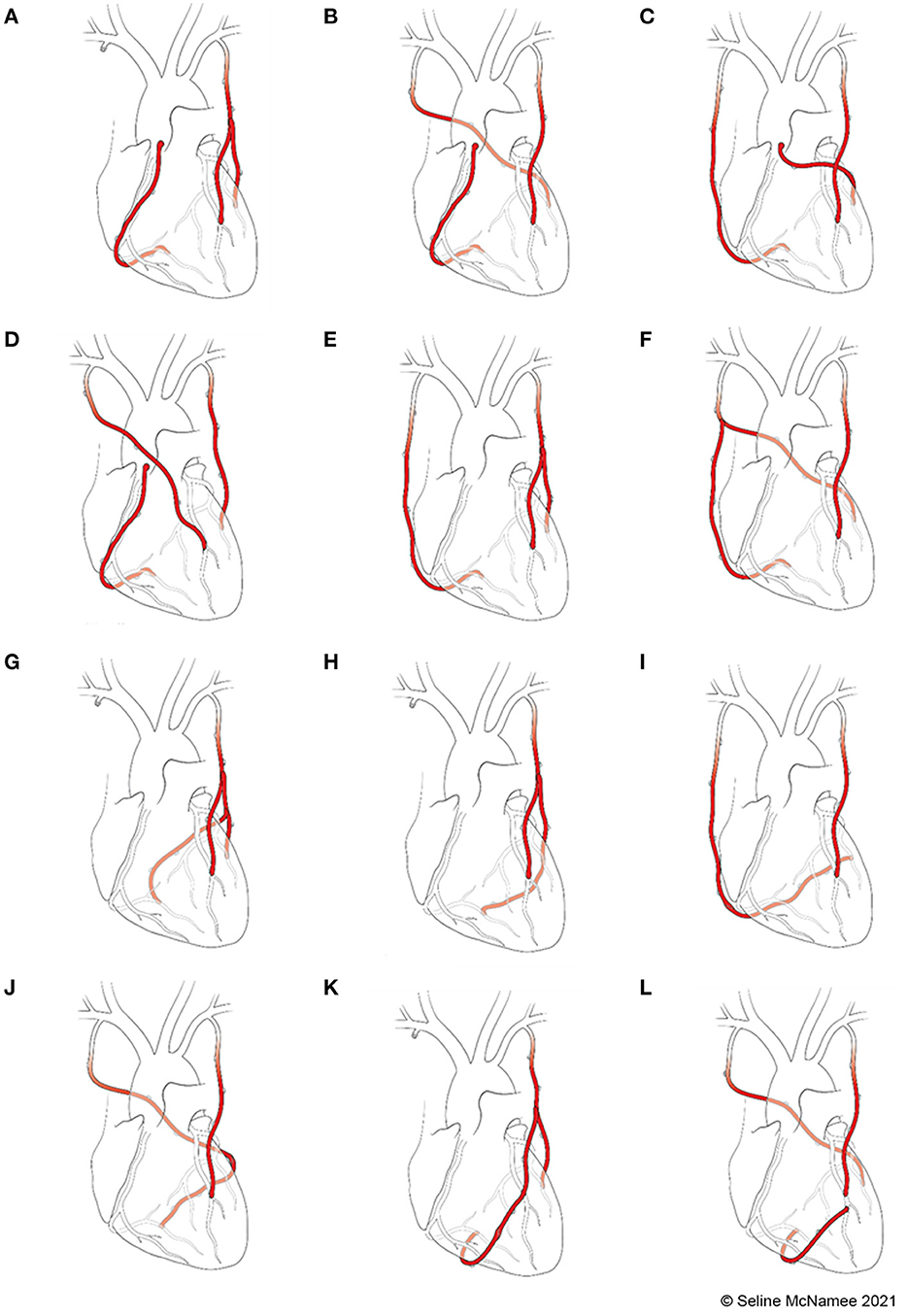Frontiers | Personalized surgical planning for coronary bypass graft ...
