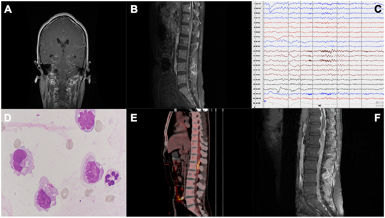 Frontiers Adult Spinal Cord Diffuse Midline Glioma H3 K27 altered Mimics Symptoms Of Central 