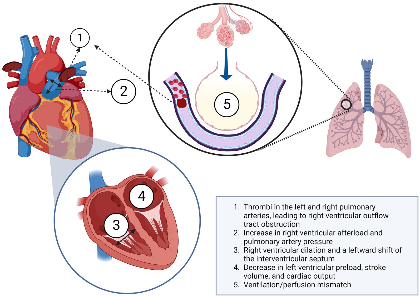 Mini Embolism