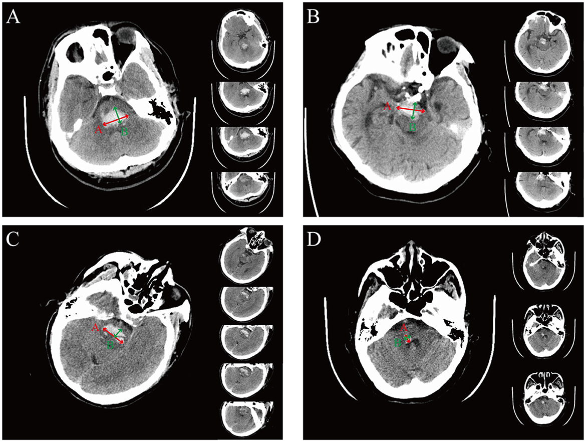 Frontiers Prognostic Models For Survival And Consciousness In