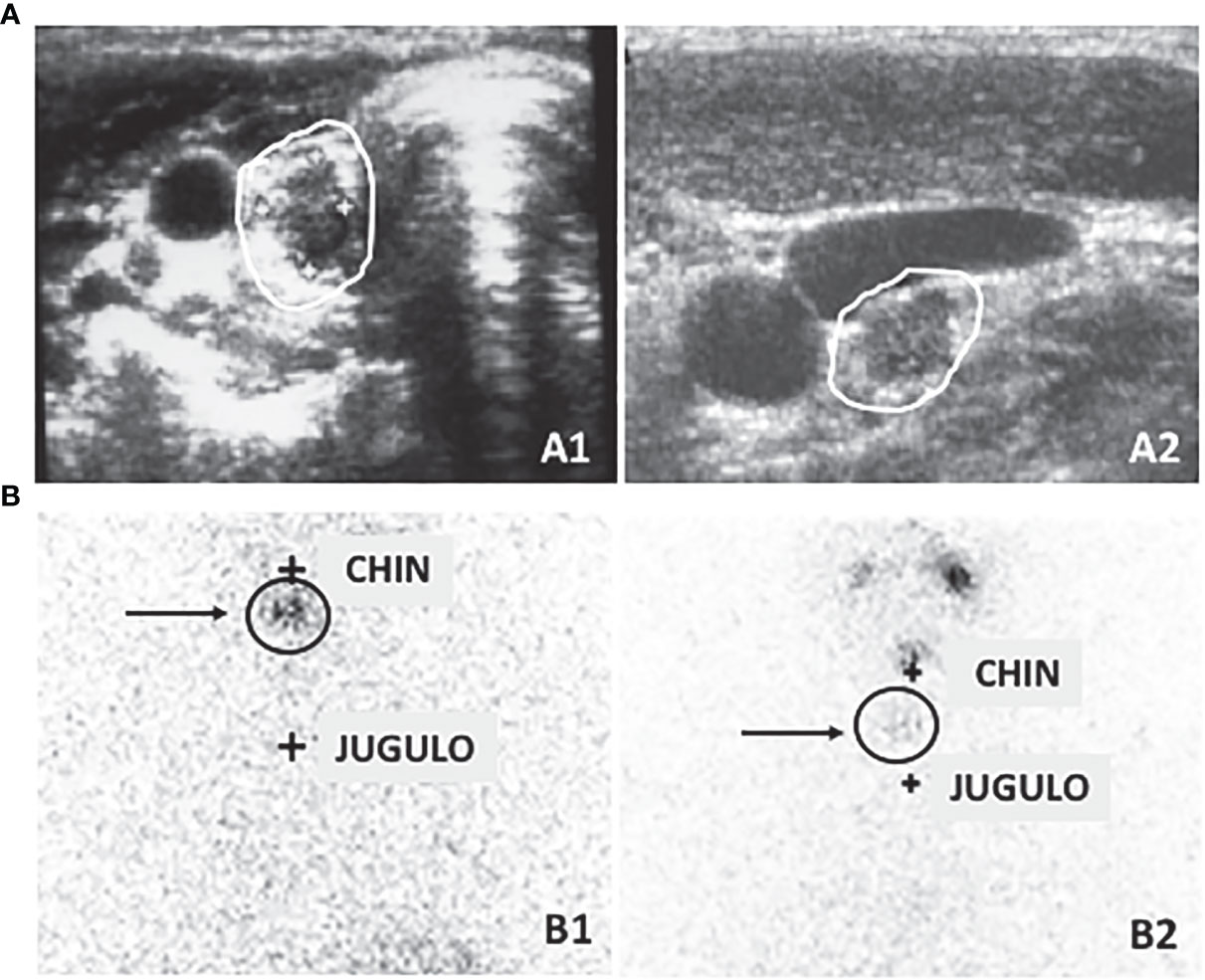 Frontiers Active Surveillance In Differentiated Thyroid Cancer A
