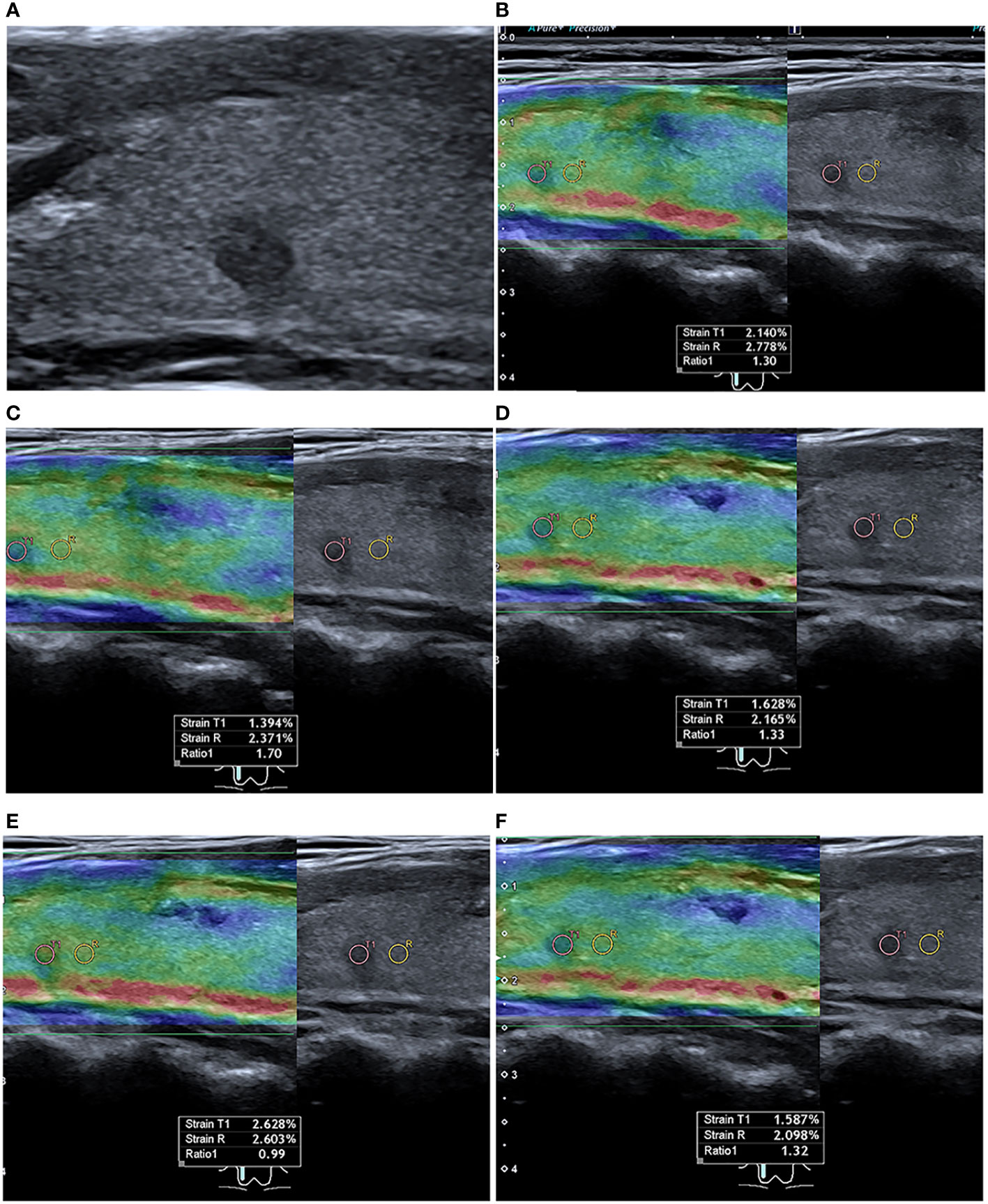 Frontiers Preoperative Strain Ultrasound Elastography Can Predict