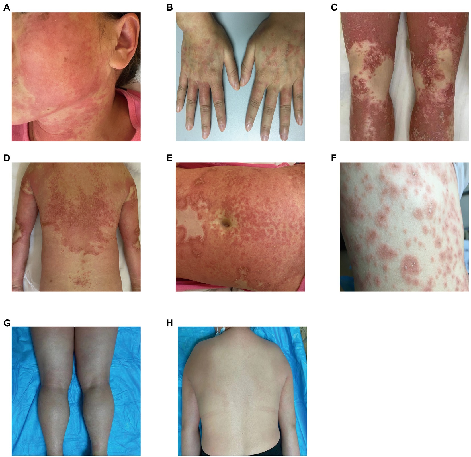 Acute Generalized Exanthematous Pustulosis