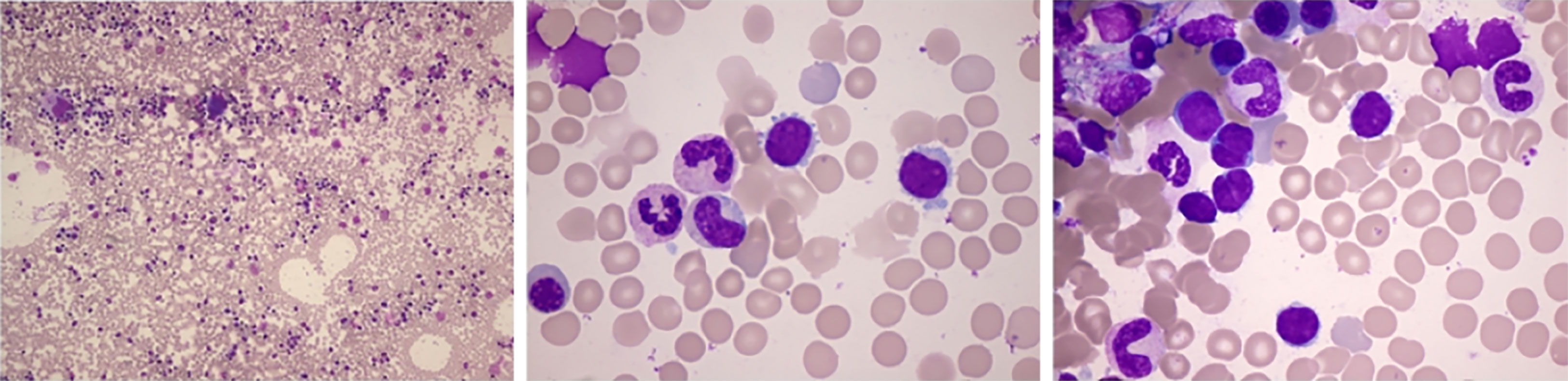 Interpreting Flow Cytometry With Caution A Case Report Of Follicular