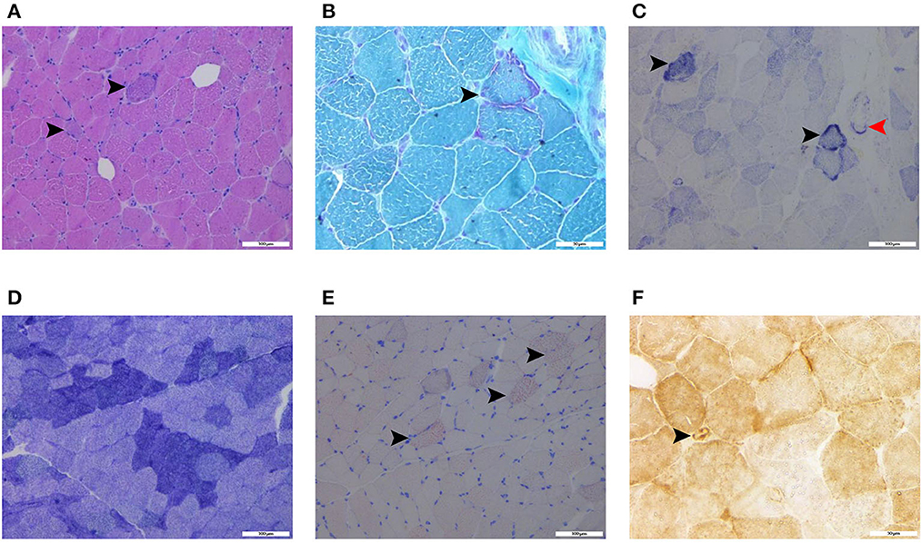 Frontiers Case Report Melas And T3271c Mitochondrial Mutation In An