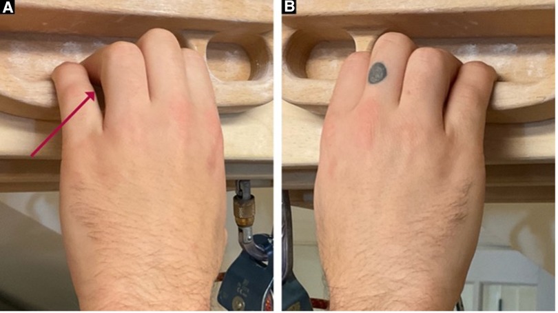 Frontiers Clinical Management Of Finger Joint Capsulitis Synovitis In