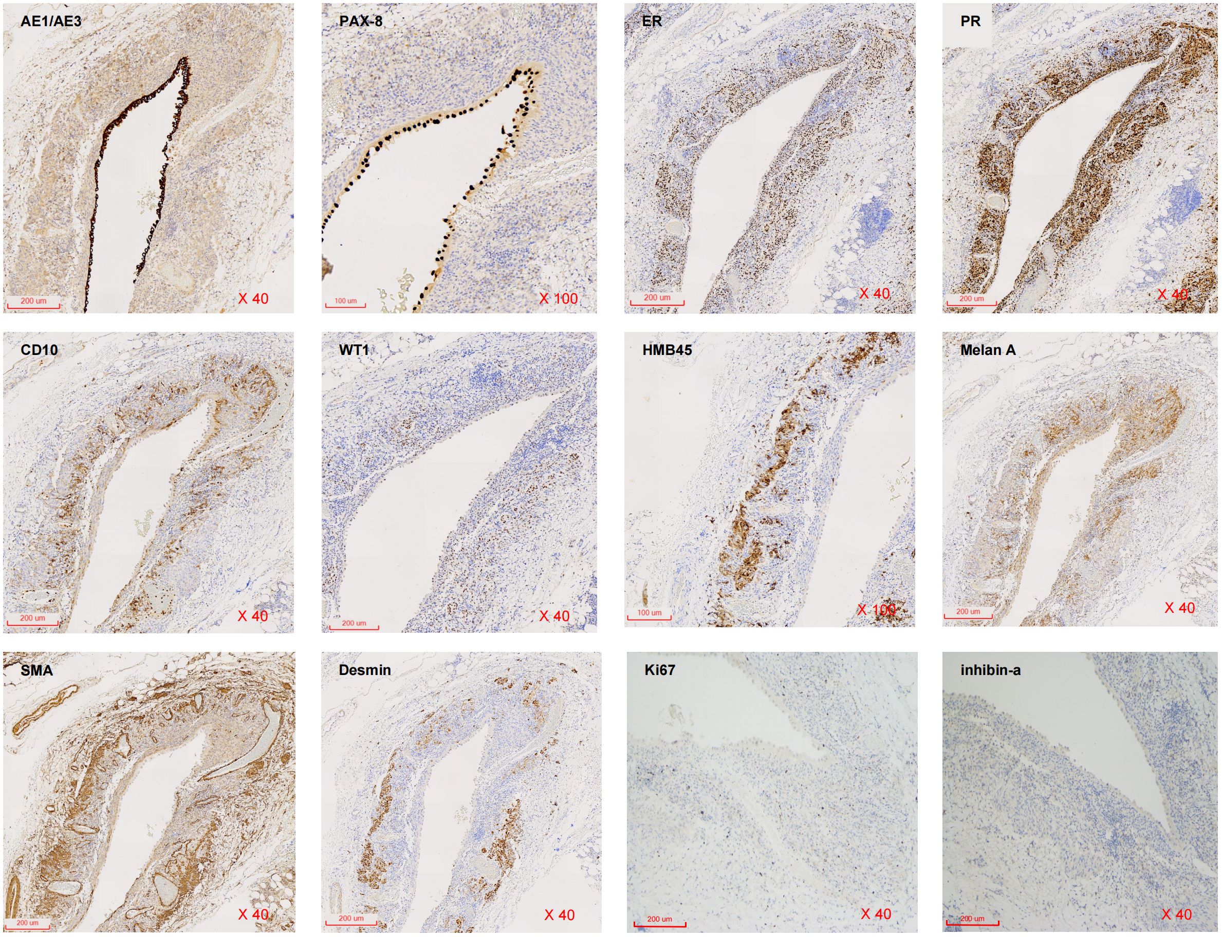 Frontiers Tsc2 Nonsense Mutation In Angiomyolipoma With Epithelial