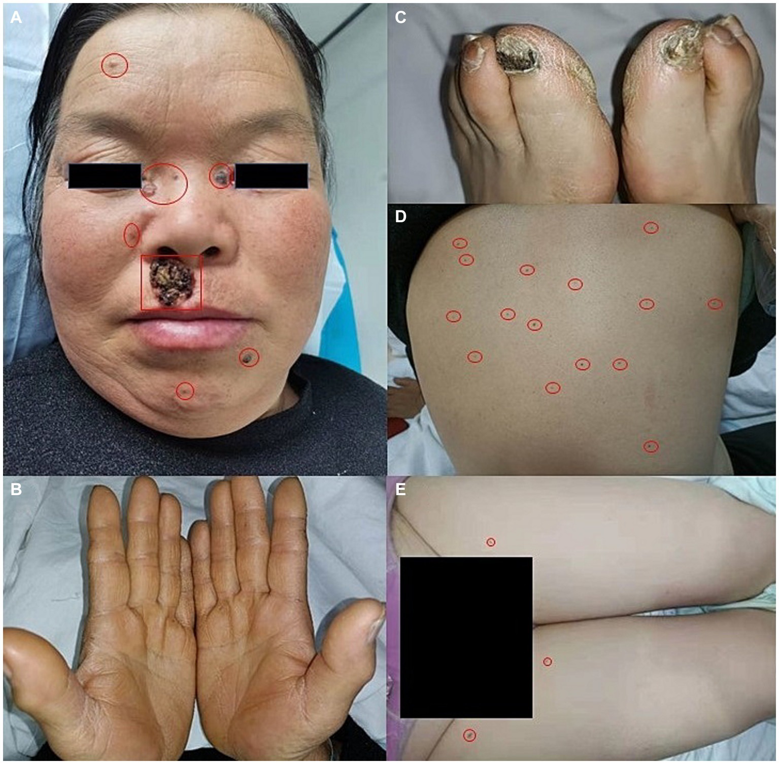 Frontiers Case Report A Novel Ptch1 Frameshift Mutation Leading To