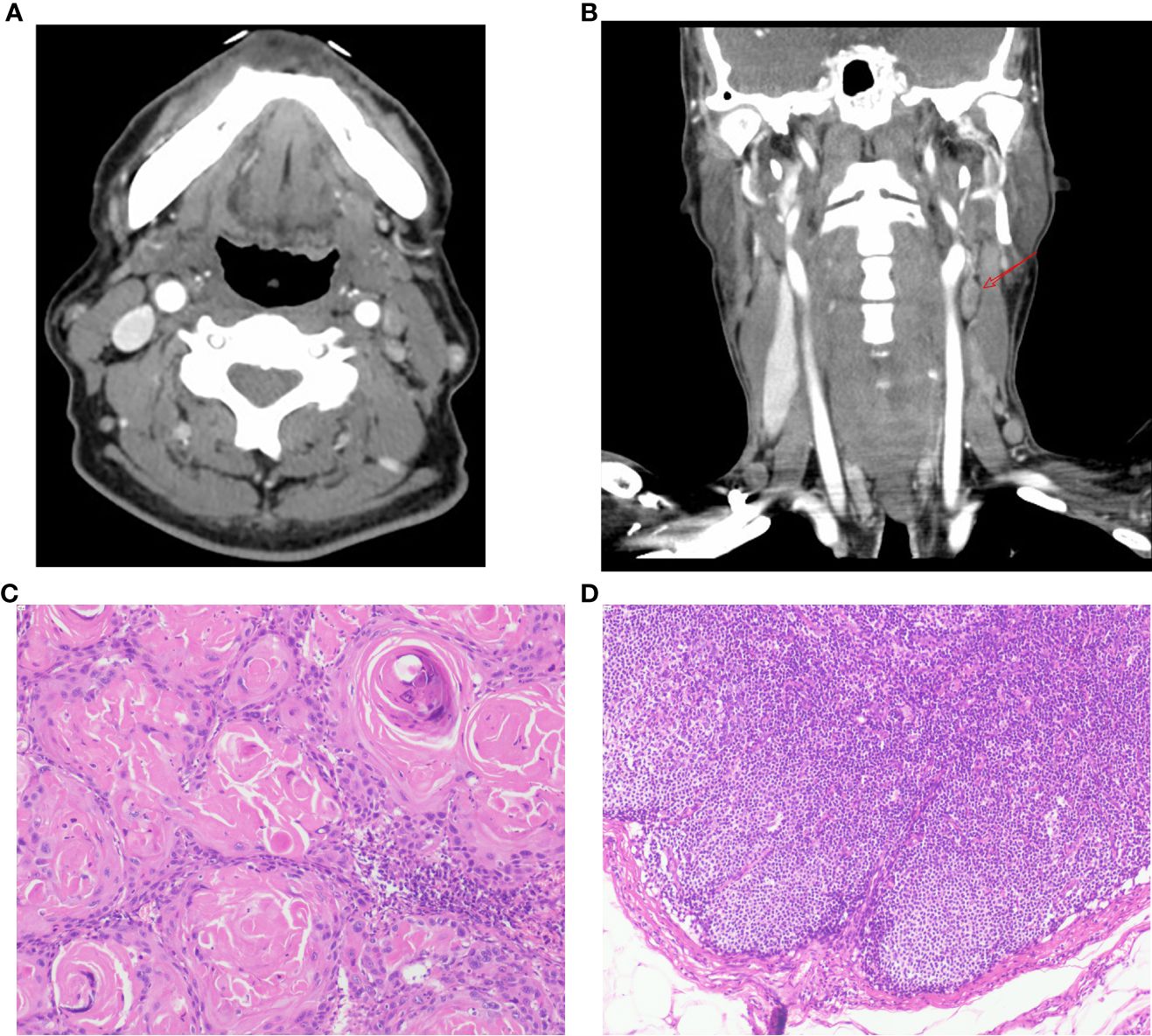 Frontiers | Development and validation of a diagnostic model for predicting cervical lymph node ...