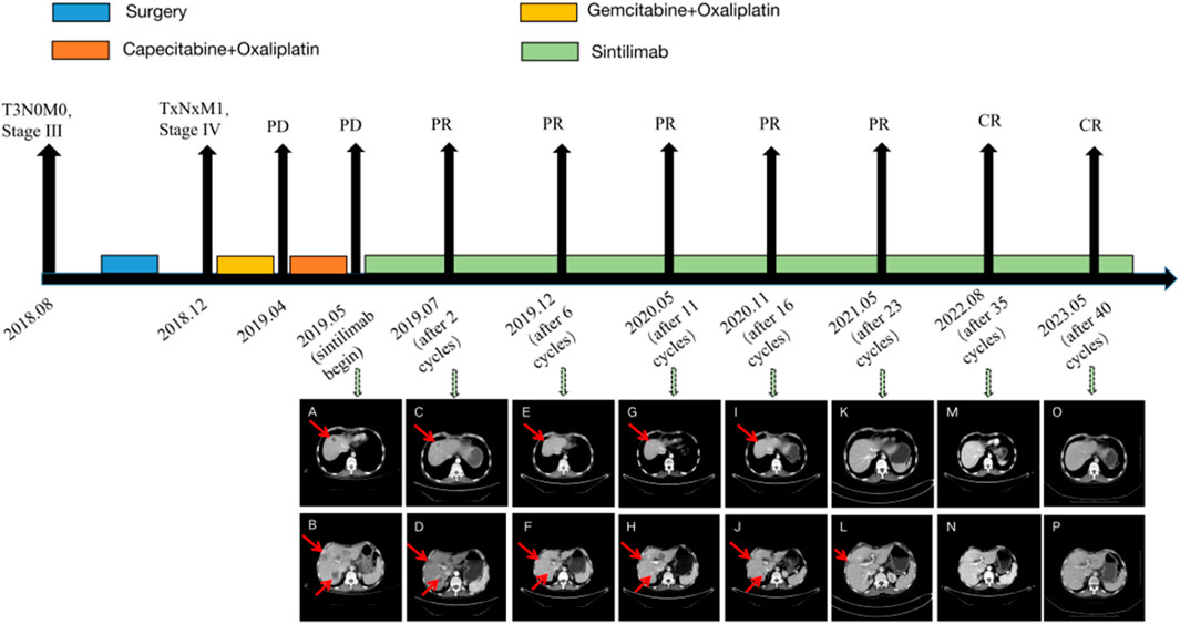 Frontiers Case Report Robust Response To Sintilimab In Advanced