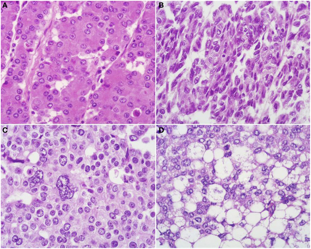 Frontiers Acinar Cell Carcinoma Of The Pancreas Overview Of