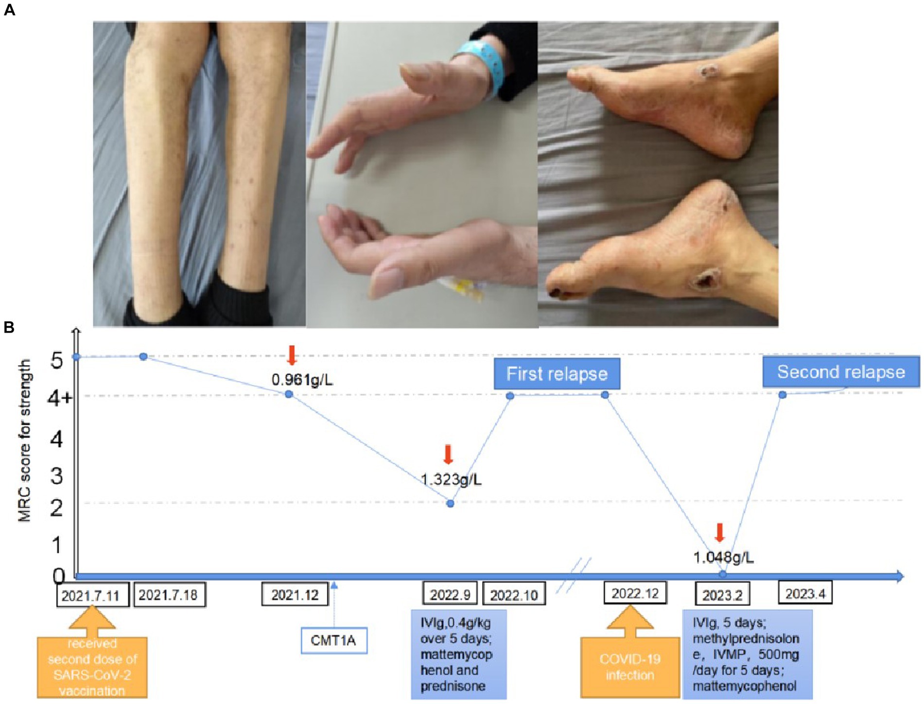 Frontiers | Case report: Chronic inflammatory demyelinating polyneuropathy superimposed on ...