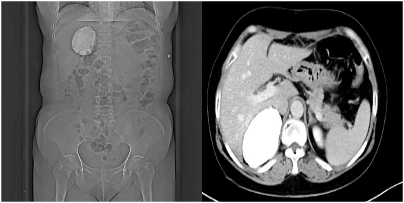 Frontiers Idiopathic Giant Adrenal Calcification A Rare Case Report