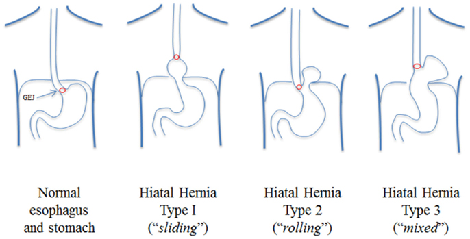 Frontiers Treatment And Controversies In Paraesophageal Hernia Repair