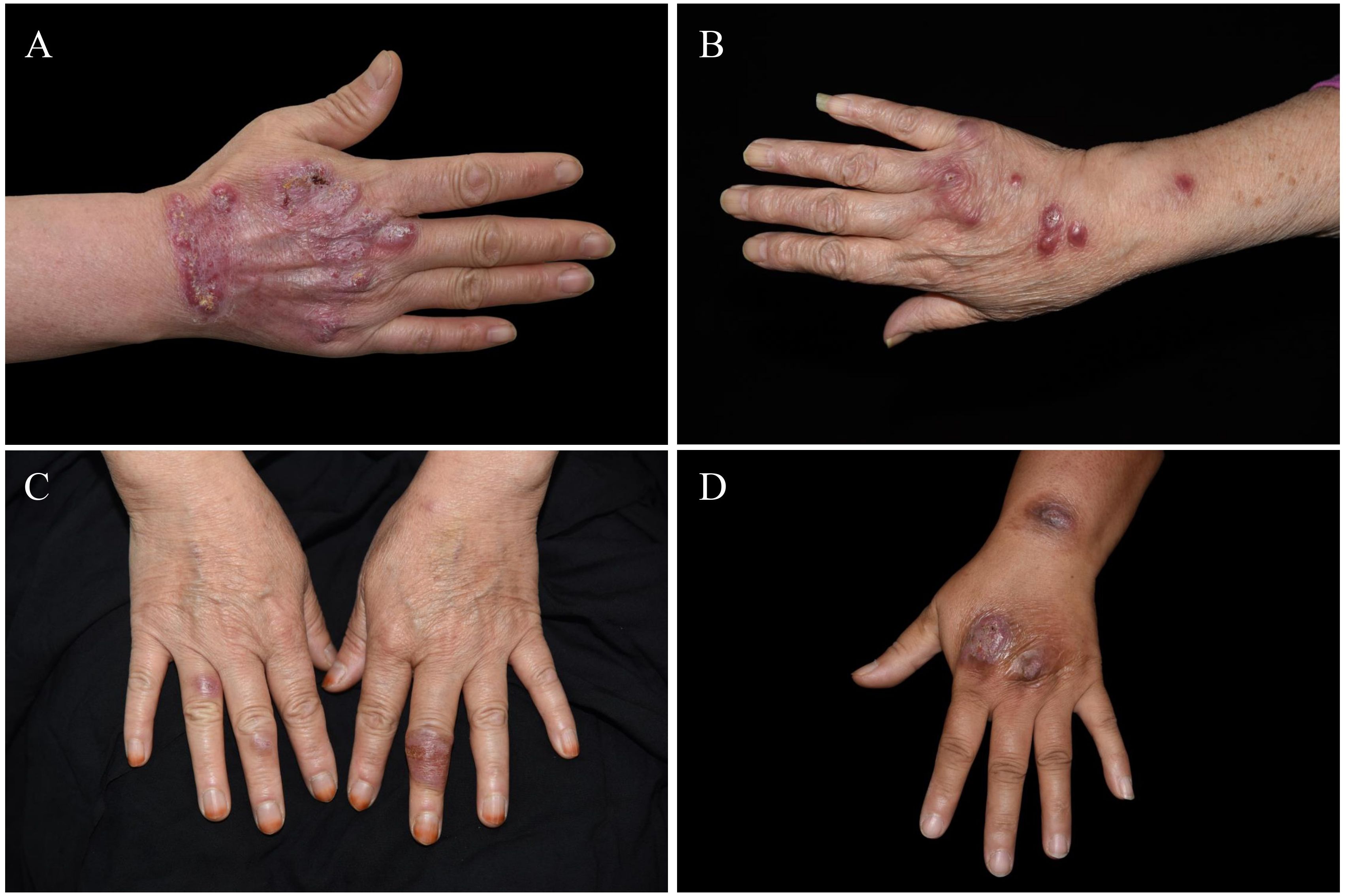 Frontiers | Investigating Cutaneous Tuberculosis and Nontuberculous Mycobacterial Infections in ...