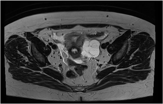 Frontiers Pseudomyxoma Peritonei A Case Report Diagnosed In A 47