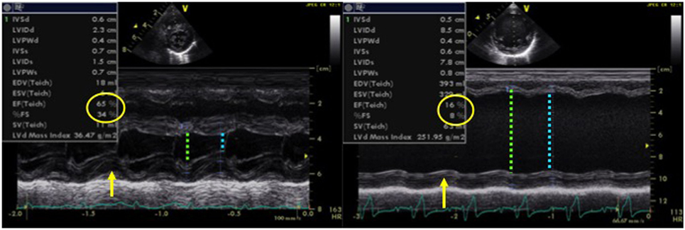 Low Normal Lv Systolic Function | semashow.com Low Normal Lv Systolic Function | semashow.com