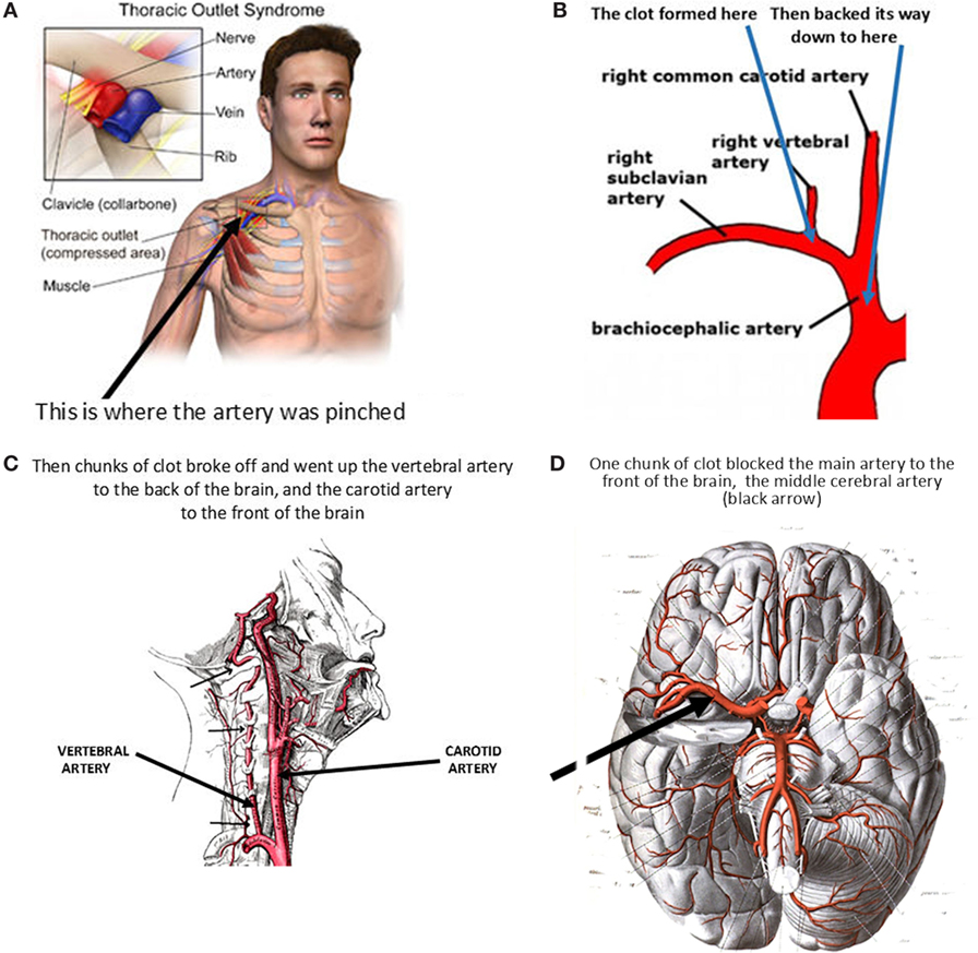 Stroke Causing Blindness Wallpaper Dodo
