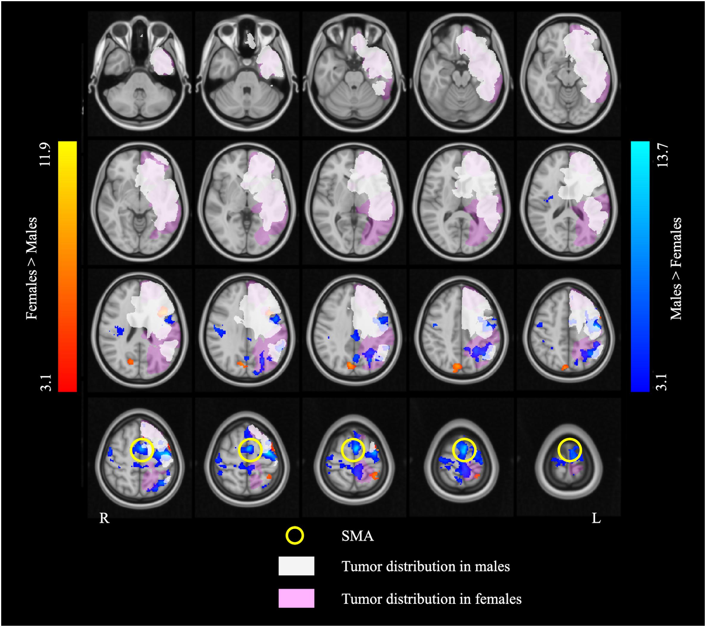 Frontiers Sex Effect On Presurgical Language Mapping In Patients With