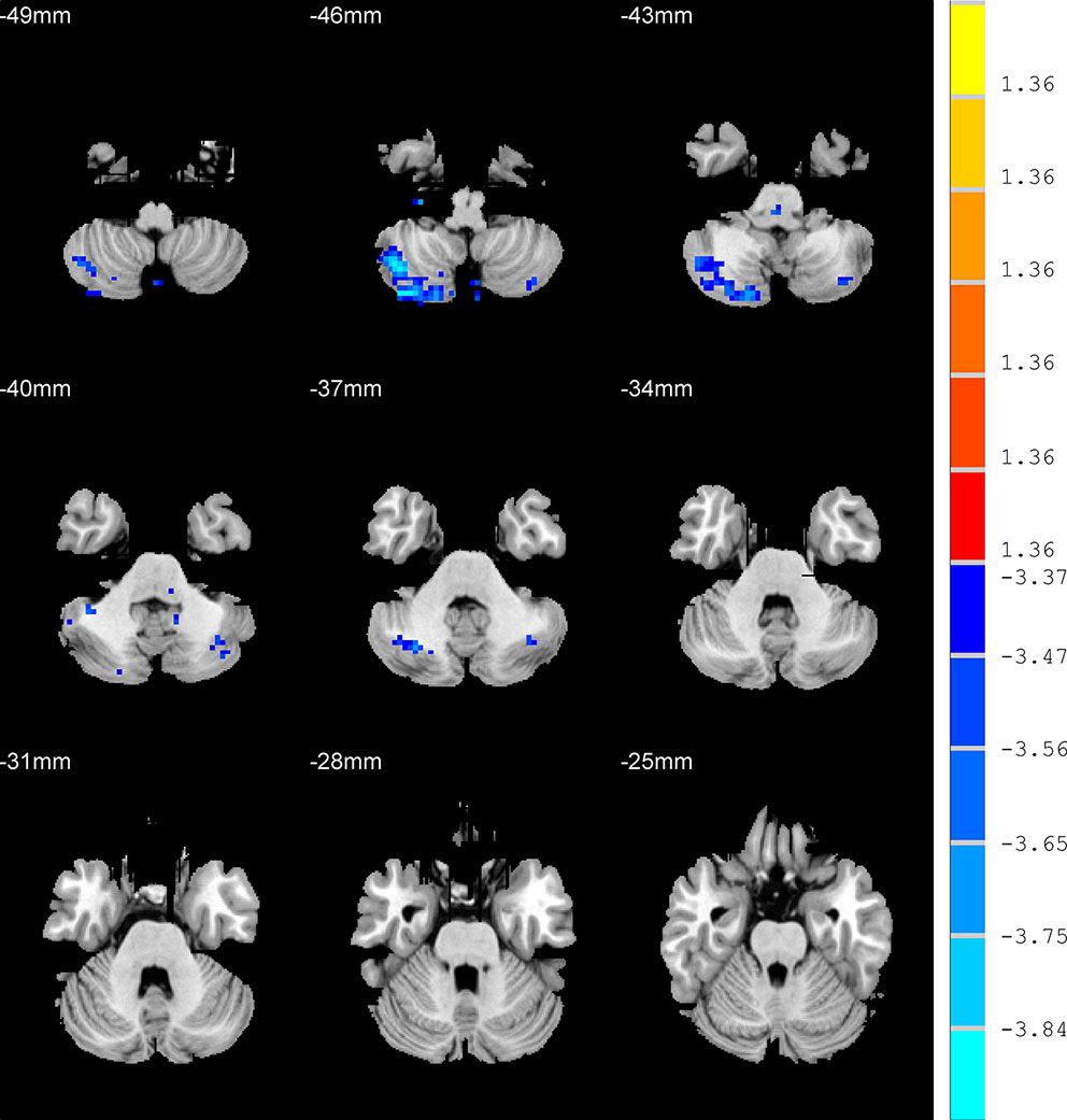 Frontiers | Reduced Resting State Neural Activity in the Right Orbital ... Frontiers | Reduced Resting State Neural Activity in the Right Orbital ...