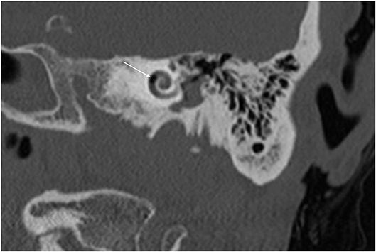 Frontiers Perilymphatic Fistula A Review Of Classification Etiology