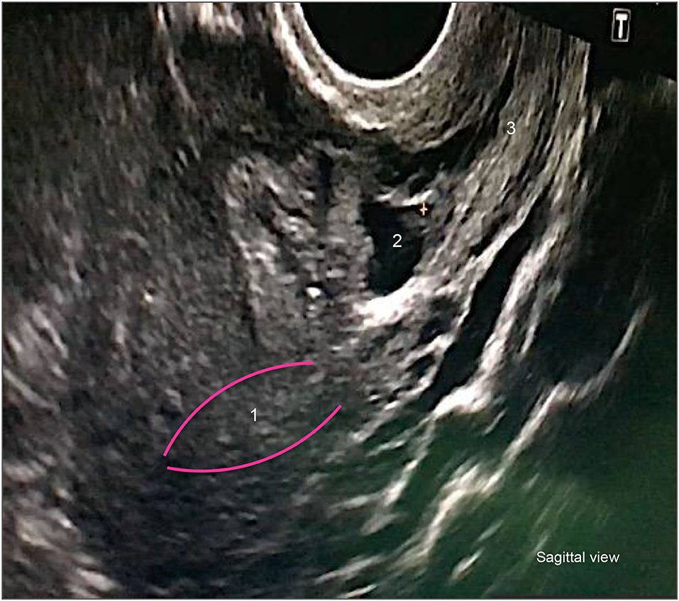 Frontiers Experience With Medical Treatment Of Cesarean Scar Ectopic
