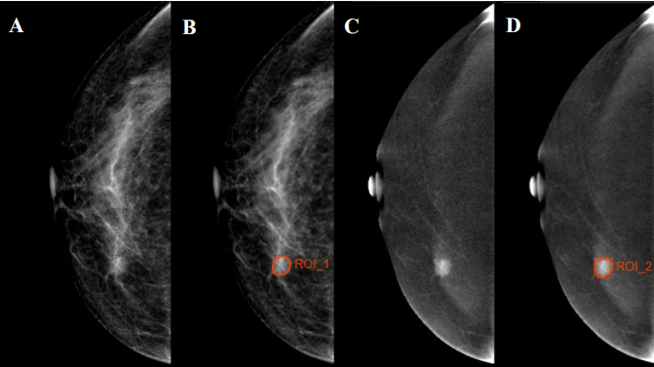 Frontiers Contrast Enhanced Spectral Mammography Based Radiomics