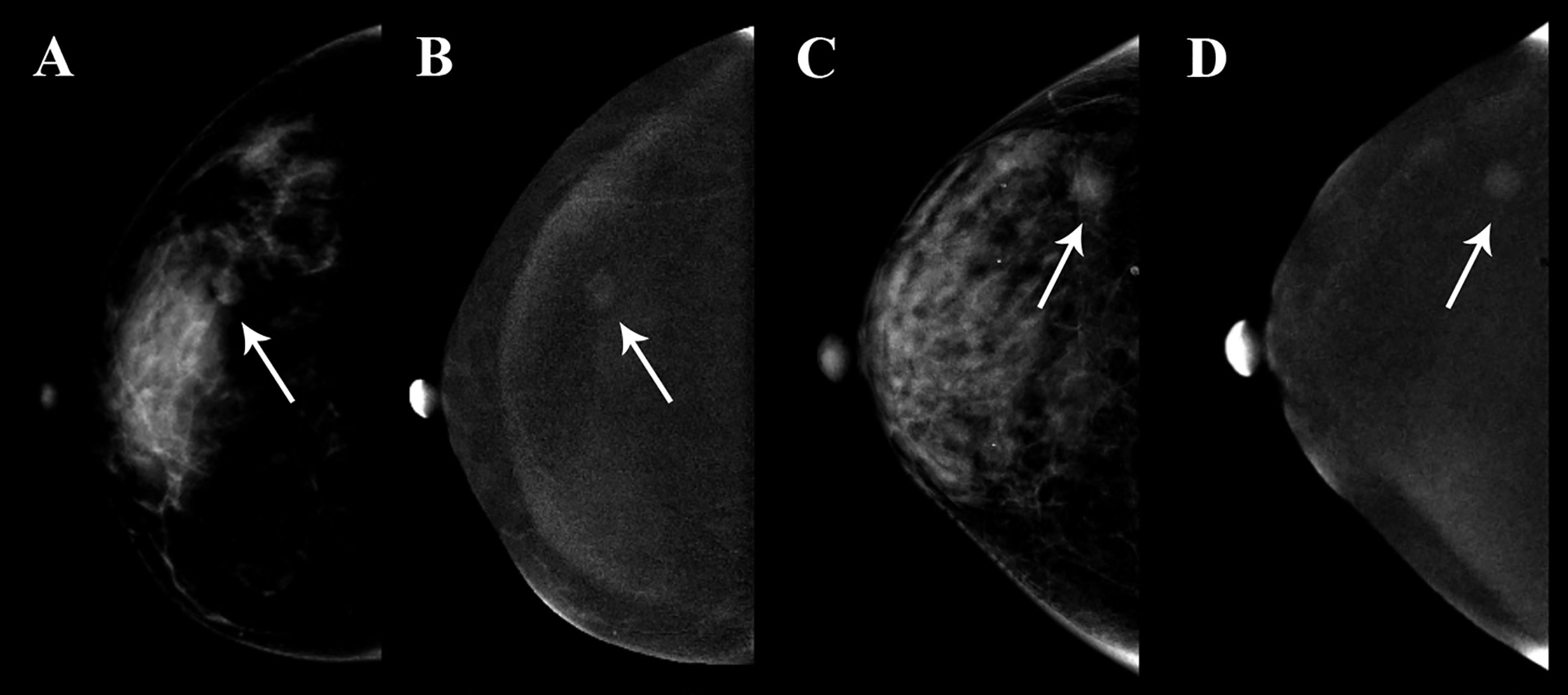 Frontiers Contrast Enhanced Spectral Mammography Based Radiomics