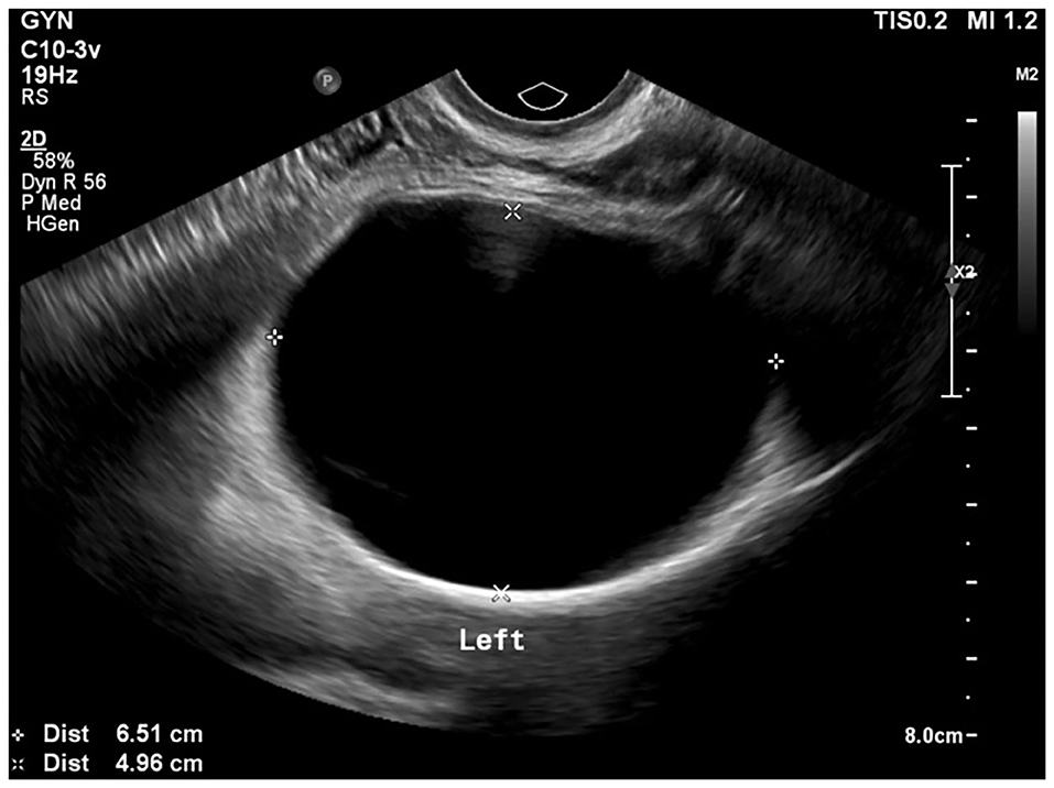 Transvaginal Ultrasound Ovarian Cysts Transvaginal Ultrasound Ovarian Cysts