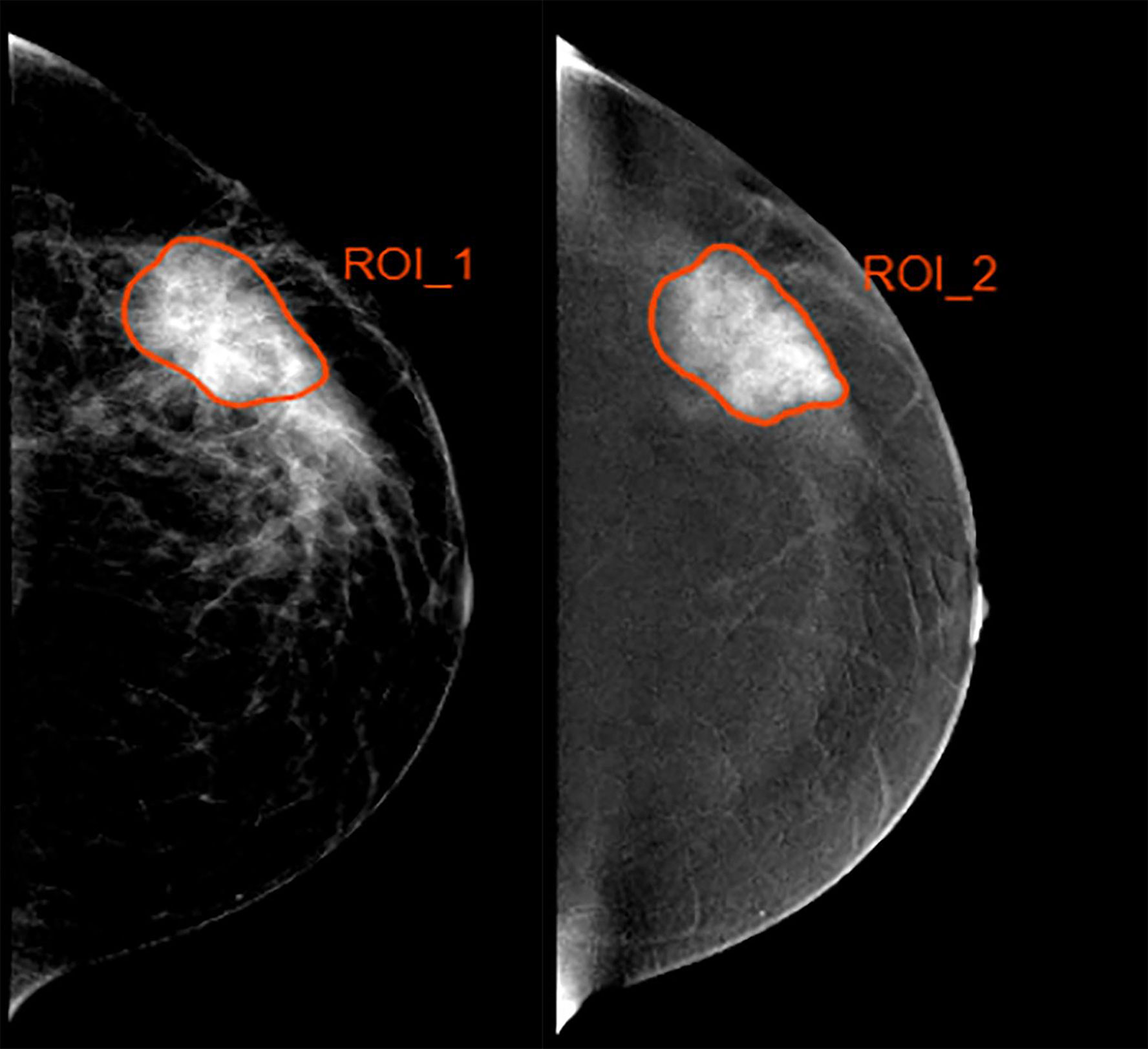 Frontiers Contrast Enhanced Spectral Mammography Based Radiomics