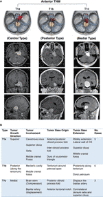 Frontiers Surgical Management Of Tentorial Notch Meningioma Guided By Further Classification