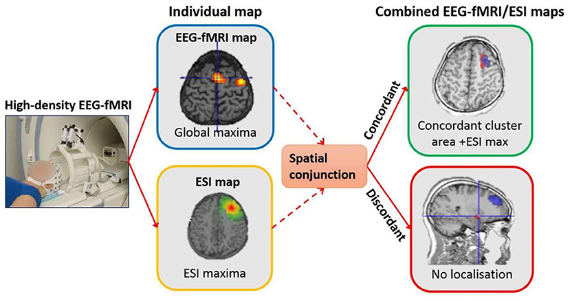 Frontiers Localization Of Epileptic Foci Based On Simultaneous Eeg