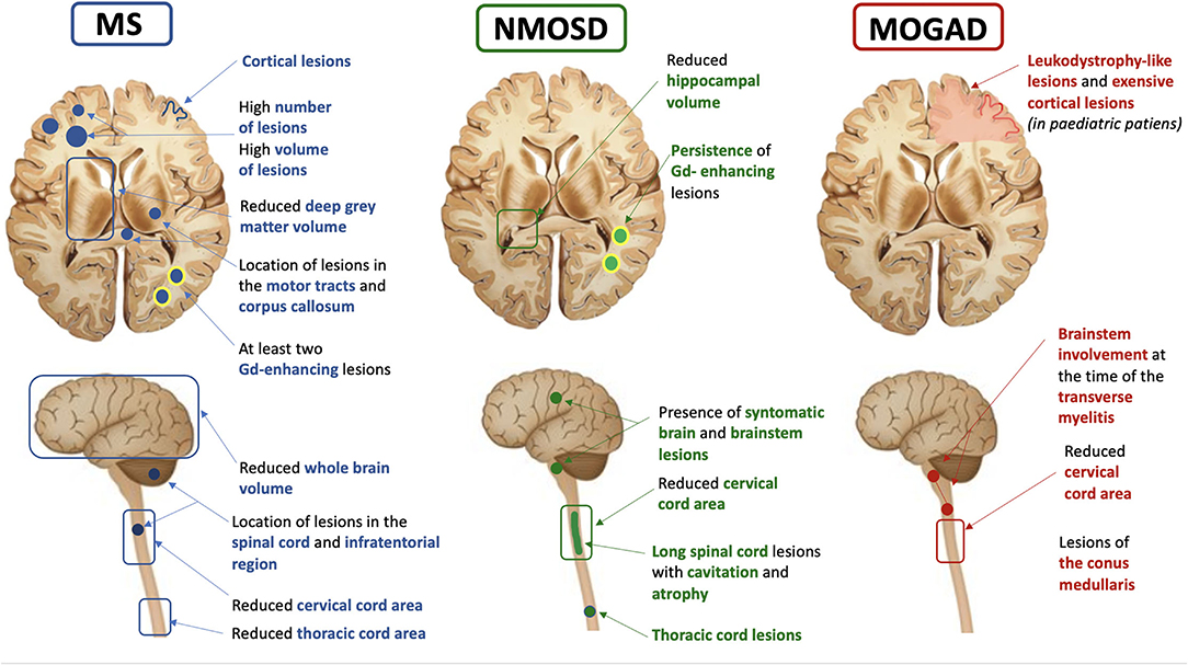 Frontiers MRI Prognostic Factors In Multiple Sclerosis Neuromyelitis 