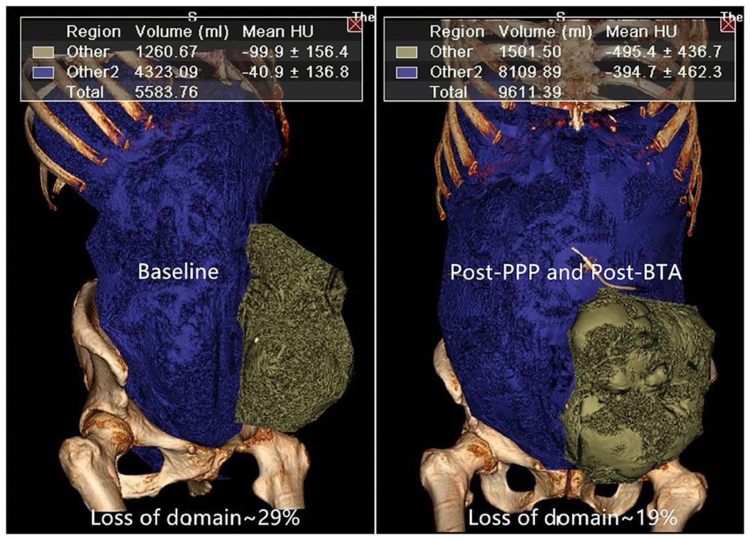Frontiers Preoperative Progressive Pneumoperitoneum And Botulinum