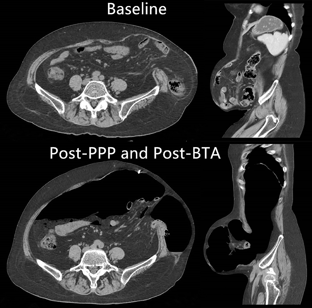 Frontiers Preoperative Progressive Pneumoperitoneum And Botulinum