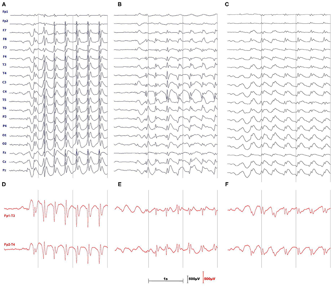 72 Hour Eeg Results Mapayakusa