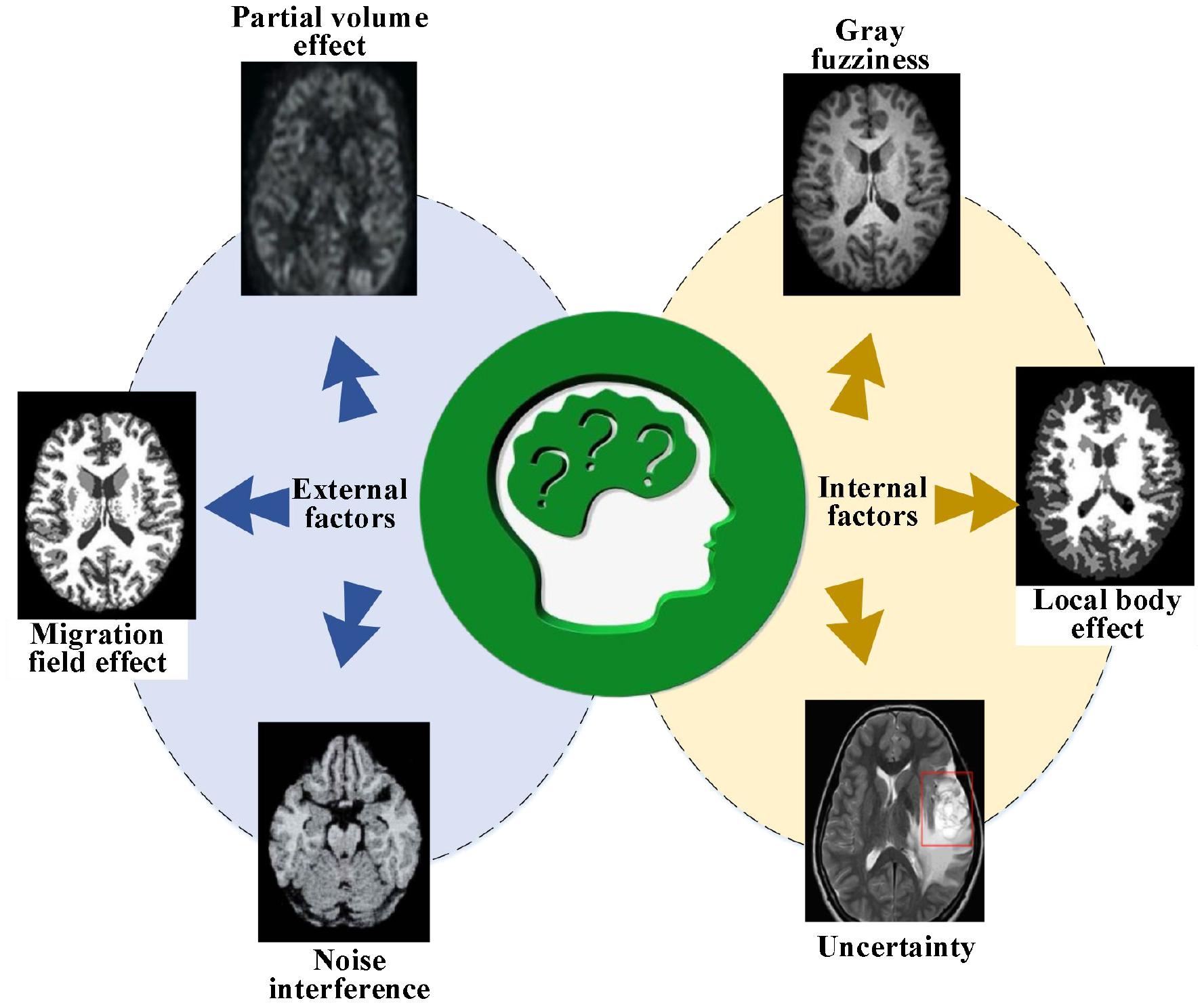 Frontiers Fuzzy System Based Medical Image Processing For Brain 