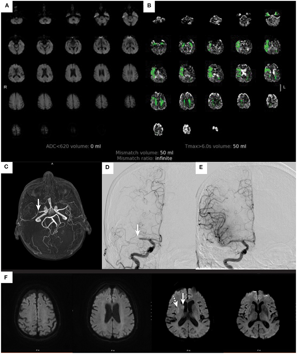 Frontiers Treatment Challenges In Acute Minor Ischemic Stroke