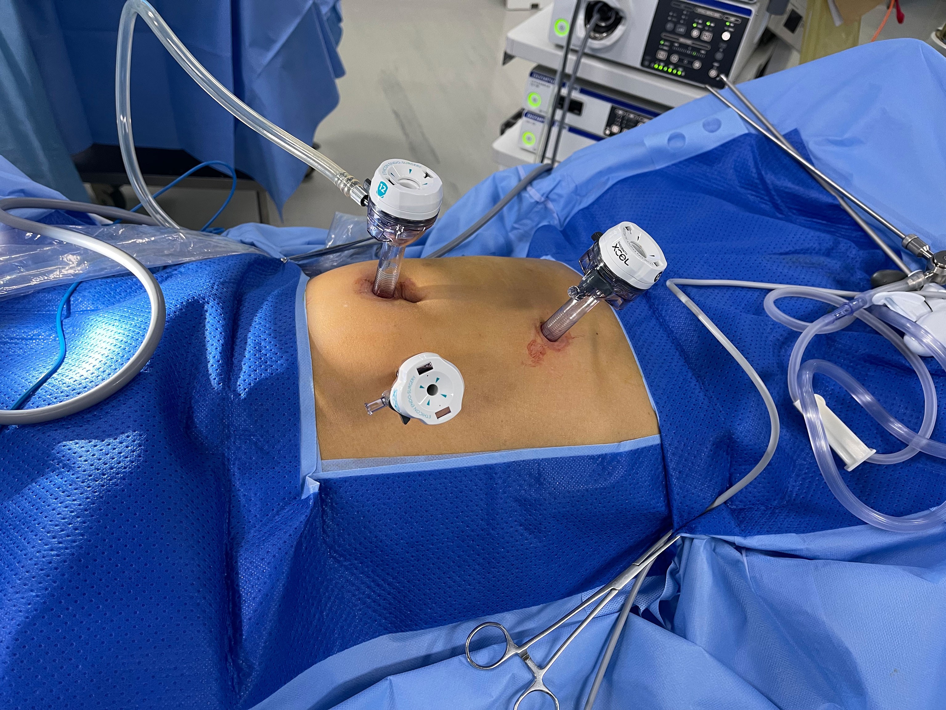 Frontiers LongTerm Outcomes Of Three Port Laparoscopic Right