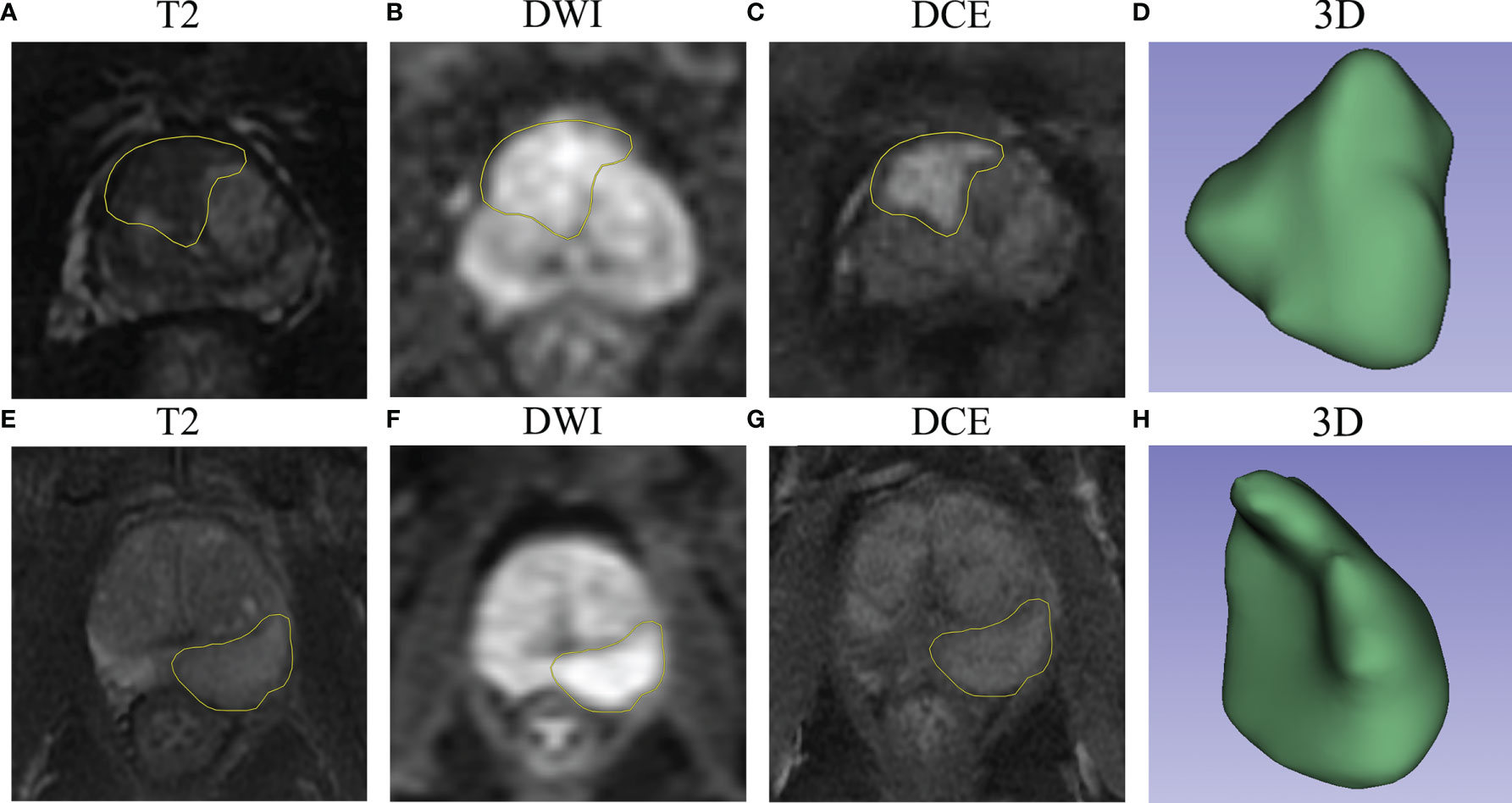 Frontiers Multiparametric Mri And Machine Learning Based Radiomic